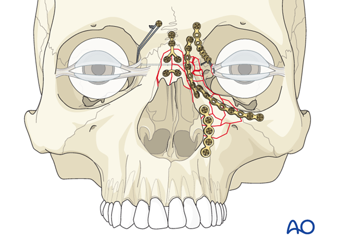 Open reduction for Nasal bone