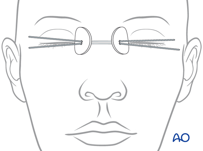 Four wall box osteotomy of the orbits for Intraorbital hypertelorism
