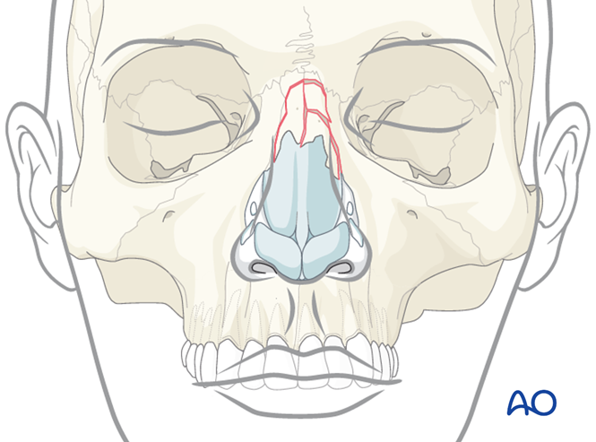 Open reduction for Nasal bone
