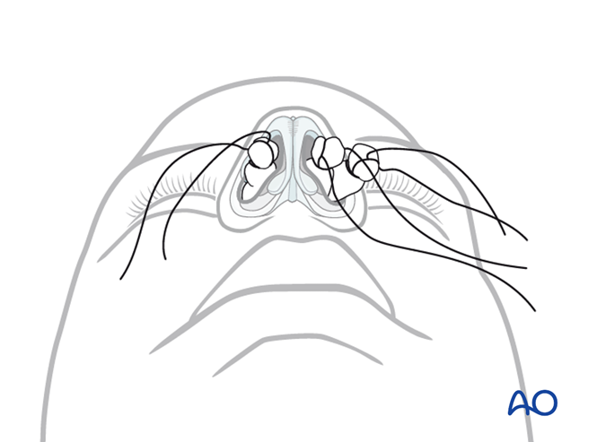 Open reduction for Nasal bone