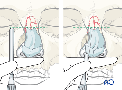 Closed reduction for Nasal bone