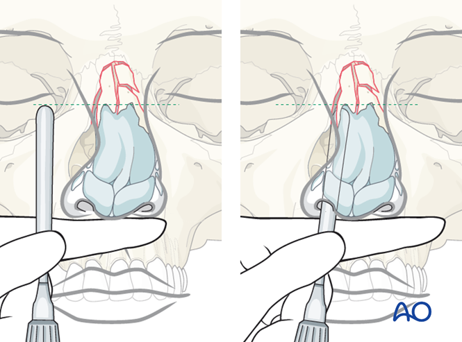 Closed reduction for Nasal bone