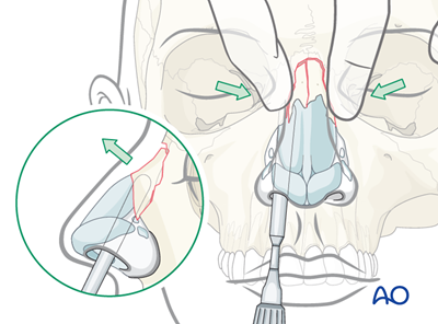 Closed reduction for Nasal bone