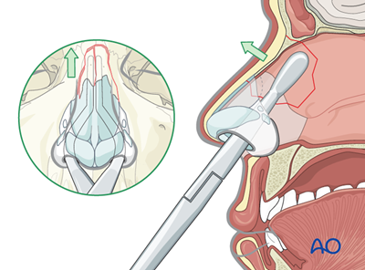 Closed reduction for Nasal bone
