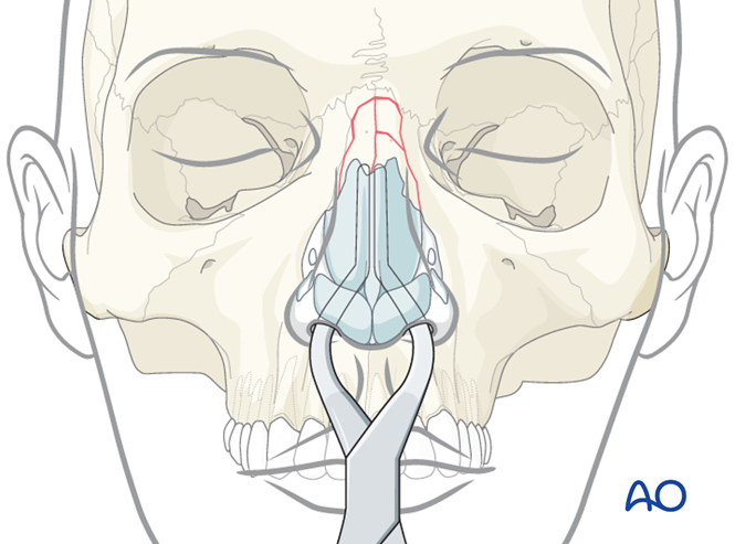 Closed reduction for Nasal bone