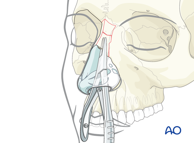 Open reduction for Nasal bone