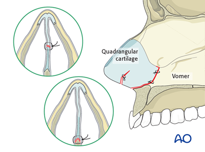 Open reduction for Nasal bone