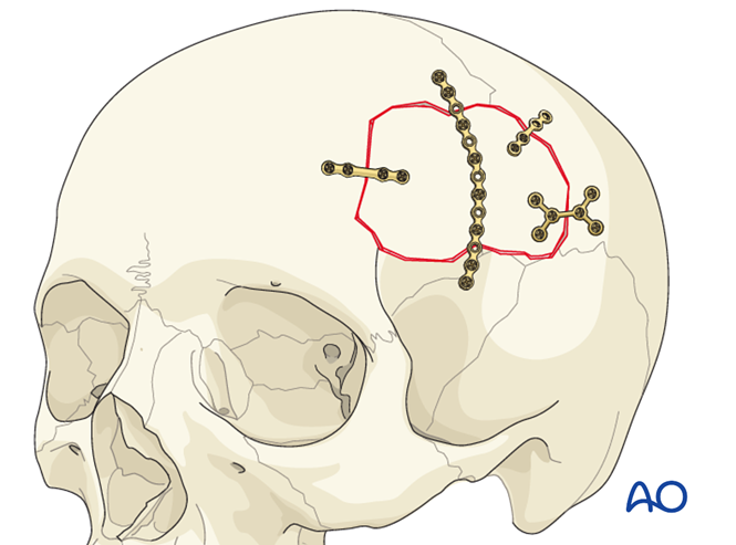 Cranioplasty (bone versus alloplast)