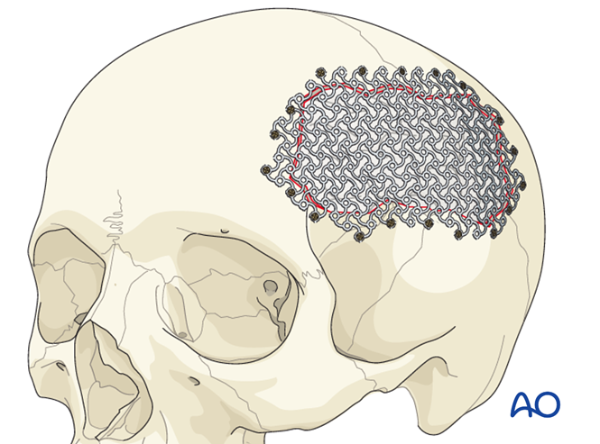 Cranioplasty (bone versus alloplast)