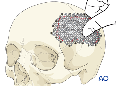 Cranioplasty (bone versus alloplast)