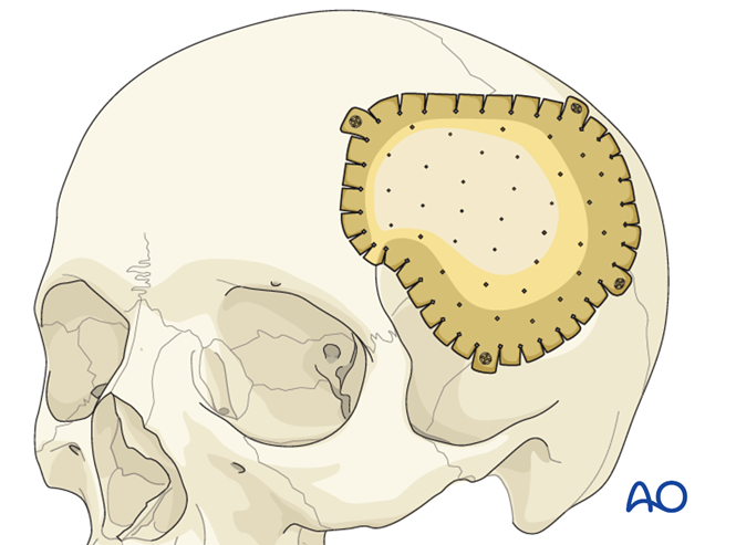 Cranioplasty (bone versus alloplast)