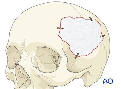 Cranioplasty (bone versus alloplast)