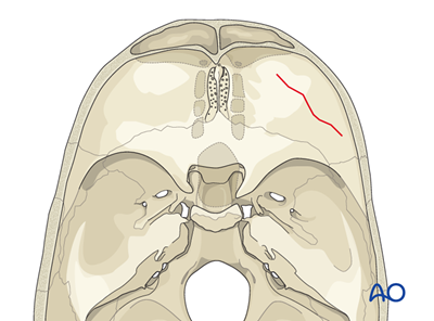 Skull base fracture, anterior