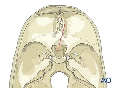 Skull base fracture, anterior