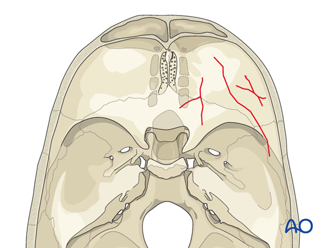 Skull base fracture, anterior