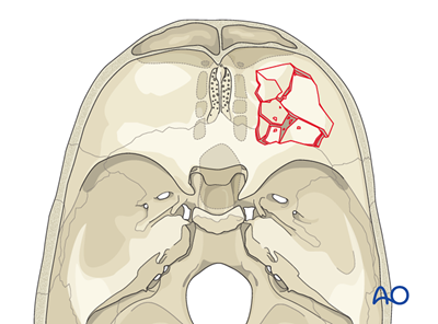 Skull base fracture, anterior