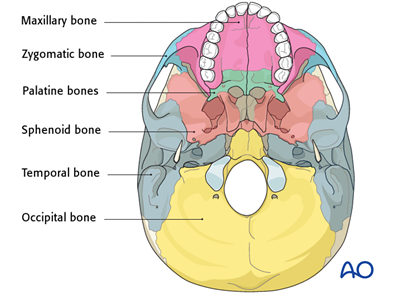 Skull base fracture, lateral