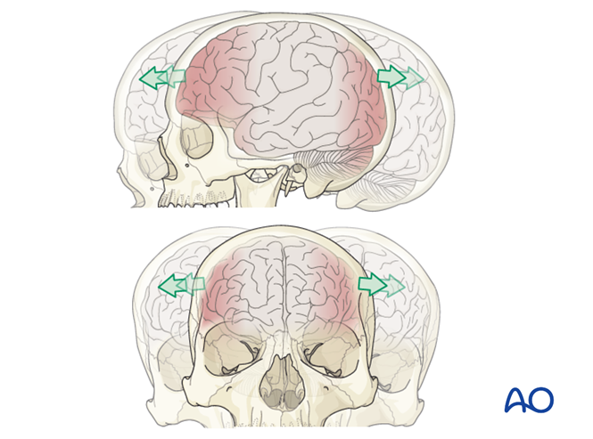Skull base fracture, anterior