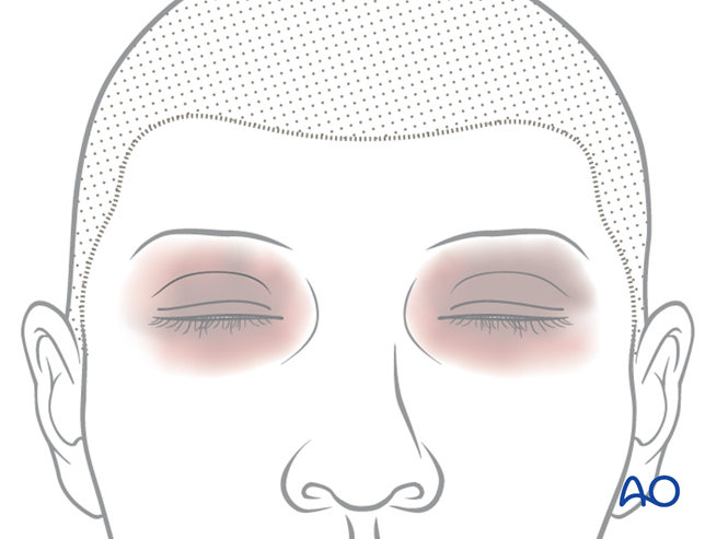 Skull base fracture, anterior