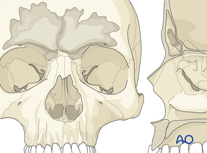 Obliteration for Frontal sinus fracture, posterior table