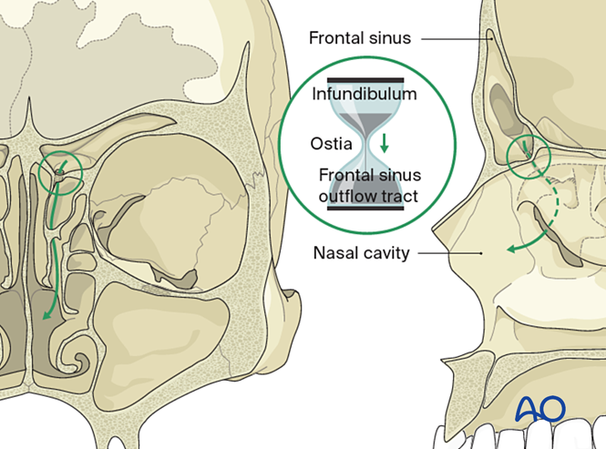 Frontal sinus fracture, frontal recess