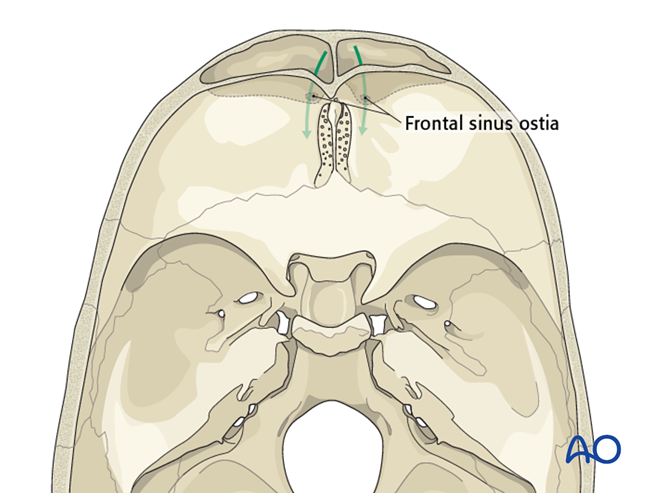 Frontal sinus fracture, anterior table