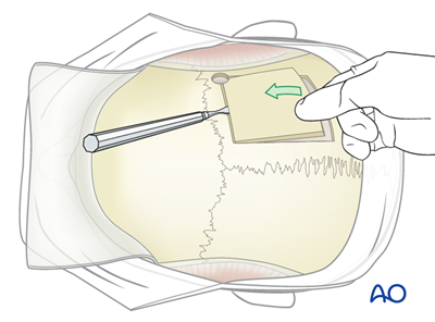 Harvesting of calvarial bone graft