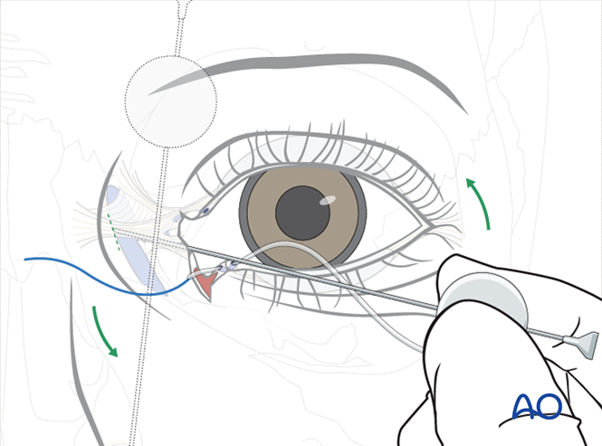 Repair of periorbital soft-tissue injuries and lacrimal system in NOE ...