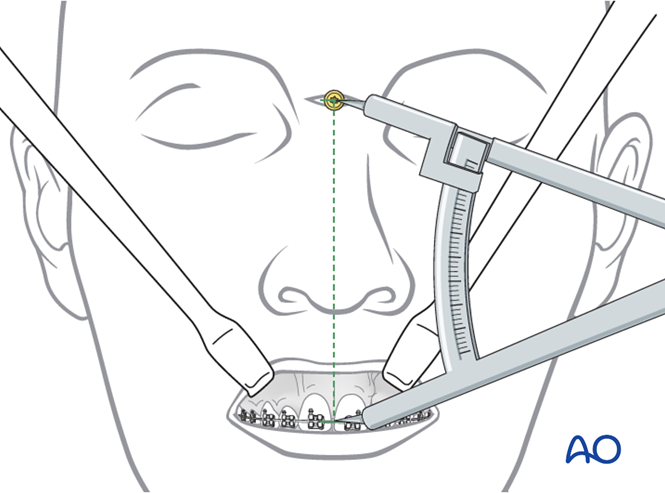 Approach to the Le Fort I level of the midface in cleft lip and palate ...