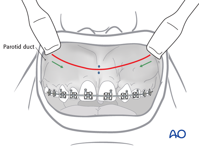 Approach to the Le Fort I level of the midface in cleft lip and palate ...