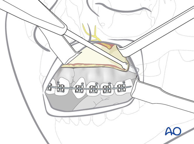 Approach to the Le Fort I level of the midface in cleft lip and palate ...