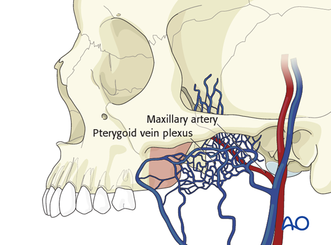 Approach to the Le Fort I level of the midface in cleft lip and palate ...