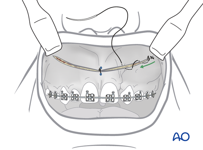 Approach to the Le Fort I level of the midface in cleft lip and palate ...