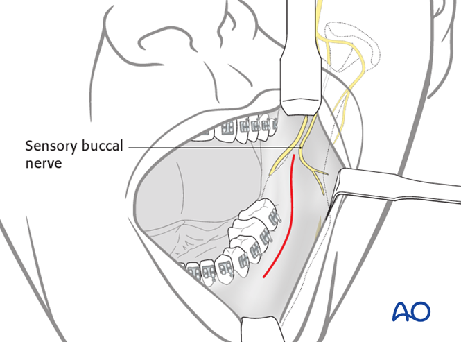 Transoral approach to the mandibular angle