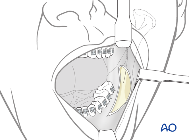 Transoral approach to the mandibular angle