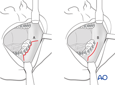 Transoral approach to the lateral mandibular body