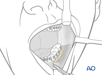 Transoral approach to the lateral mandibular body