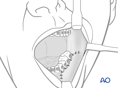 Transoral approach to the lateral mandibular body