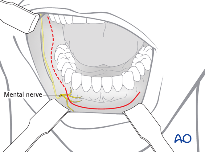Transoral approach to the chin