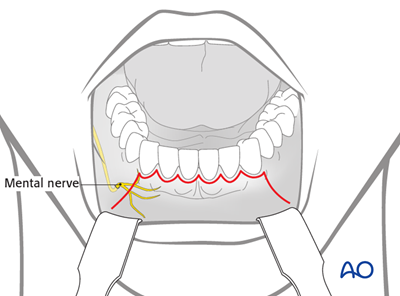Transoral approach to the chin