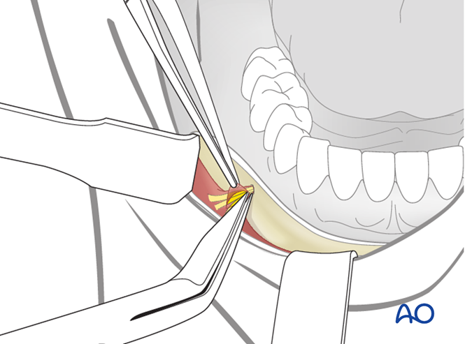 Transoral approach to the chin