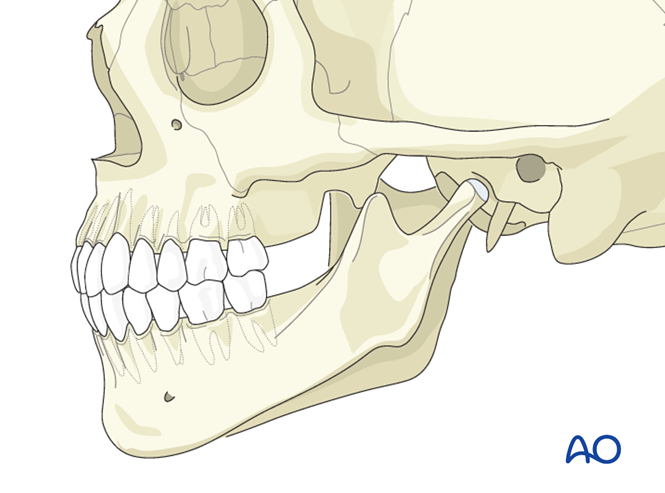 Hemifacial Microsomia - Classification