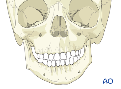 Hemifacial Microsomia - Classification