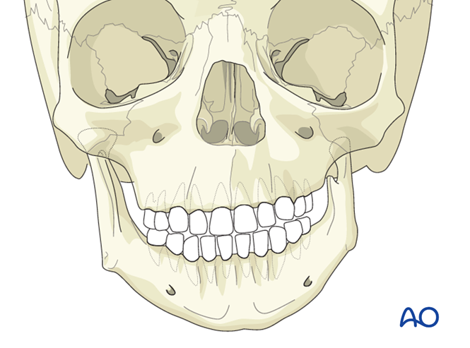 Hemifacial Microsomia - Classification