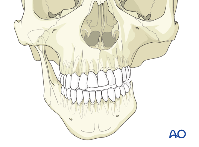 Hemifacial Microsomia - Classification