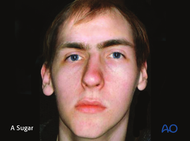 Hemifacial Microsomia - Classification