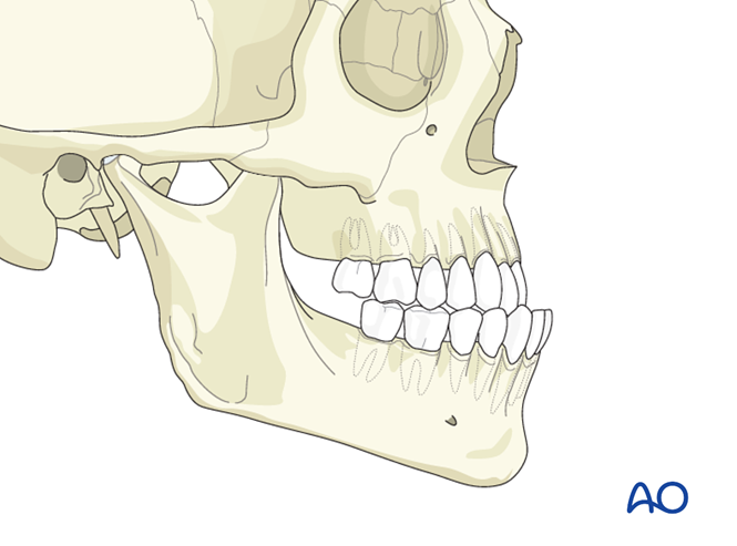 Mandibular prognathism