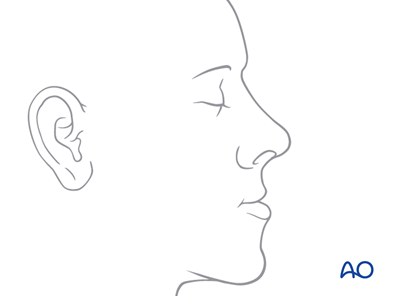Mandibular prognathism