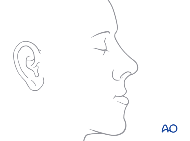 Mandibular prognathism