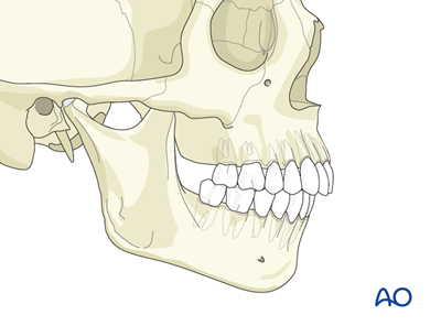 Mandibular retrognathism